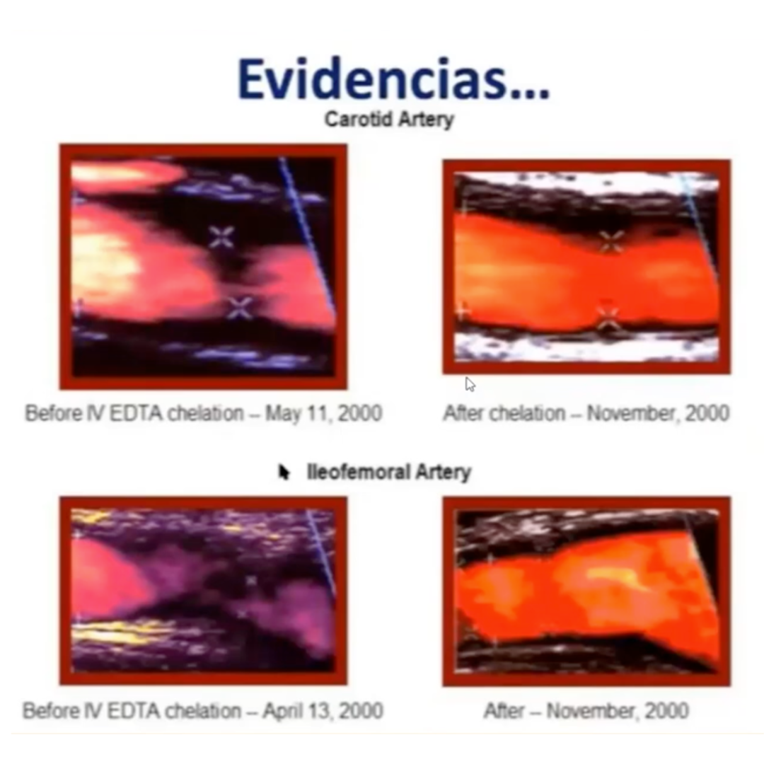 TERAPIA DE QUELACIÓN – CENTRO MÉDICO MONOBE